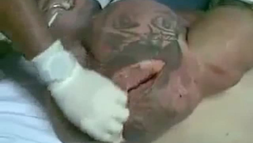 Arm Exploded Due to steroid injection - GoreSee - Death is Watching over You